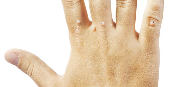 Verrues; verruca; verrucas; wart